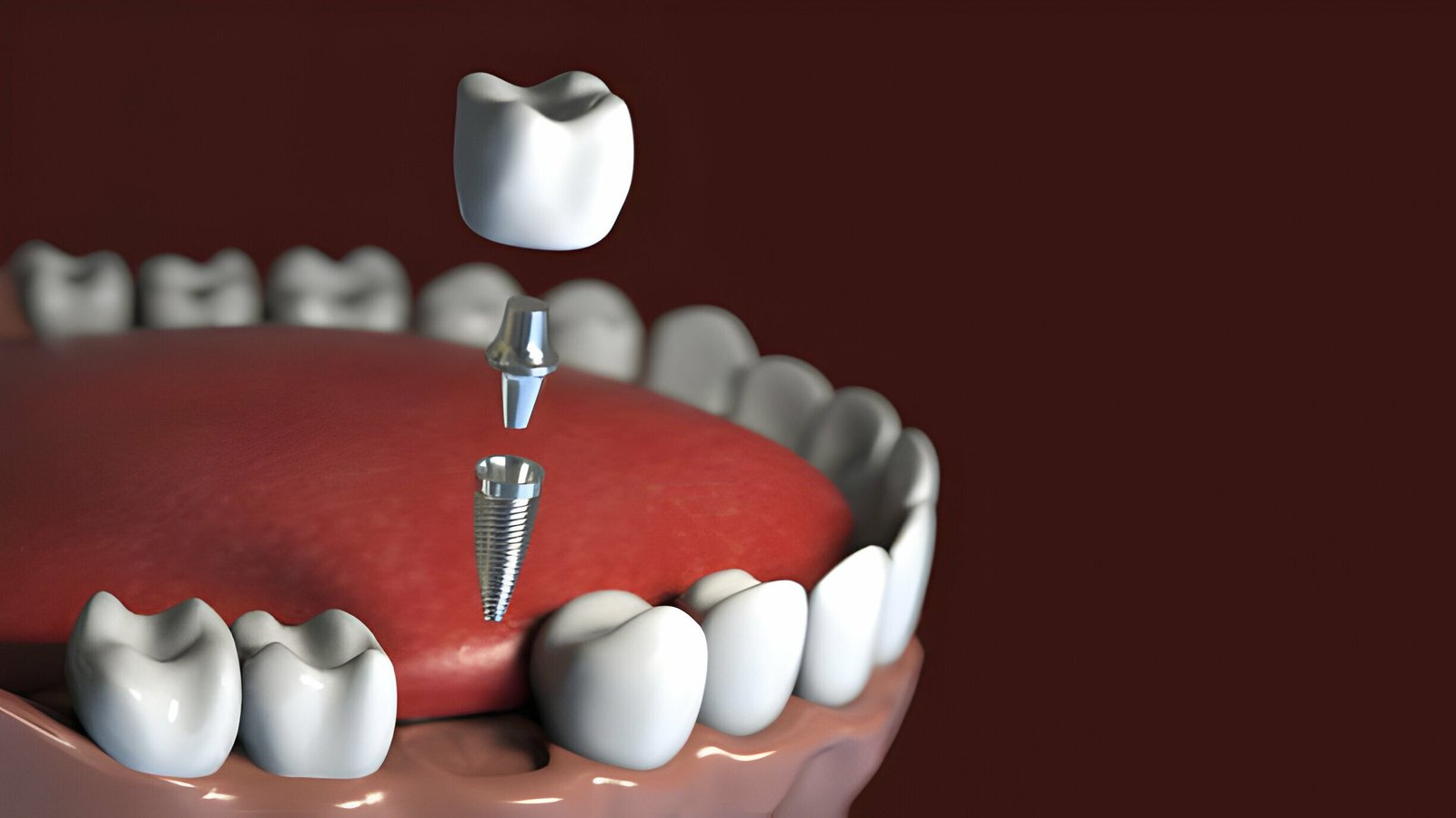 Are you ever too old for dental implants?